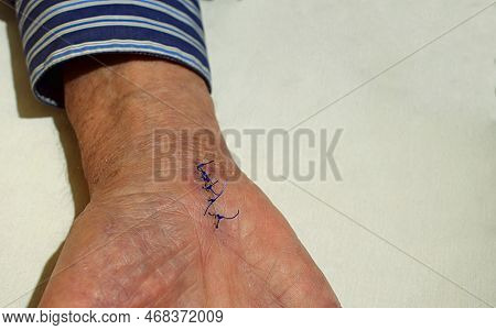 Suture On Arm After Image & Photo (Free Trial) | Bigstock