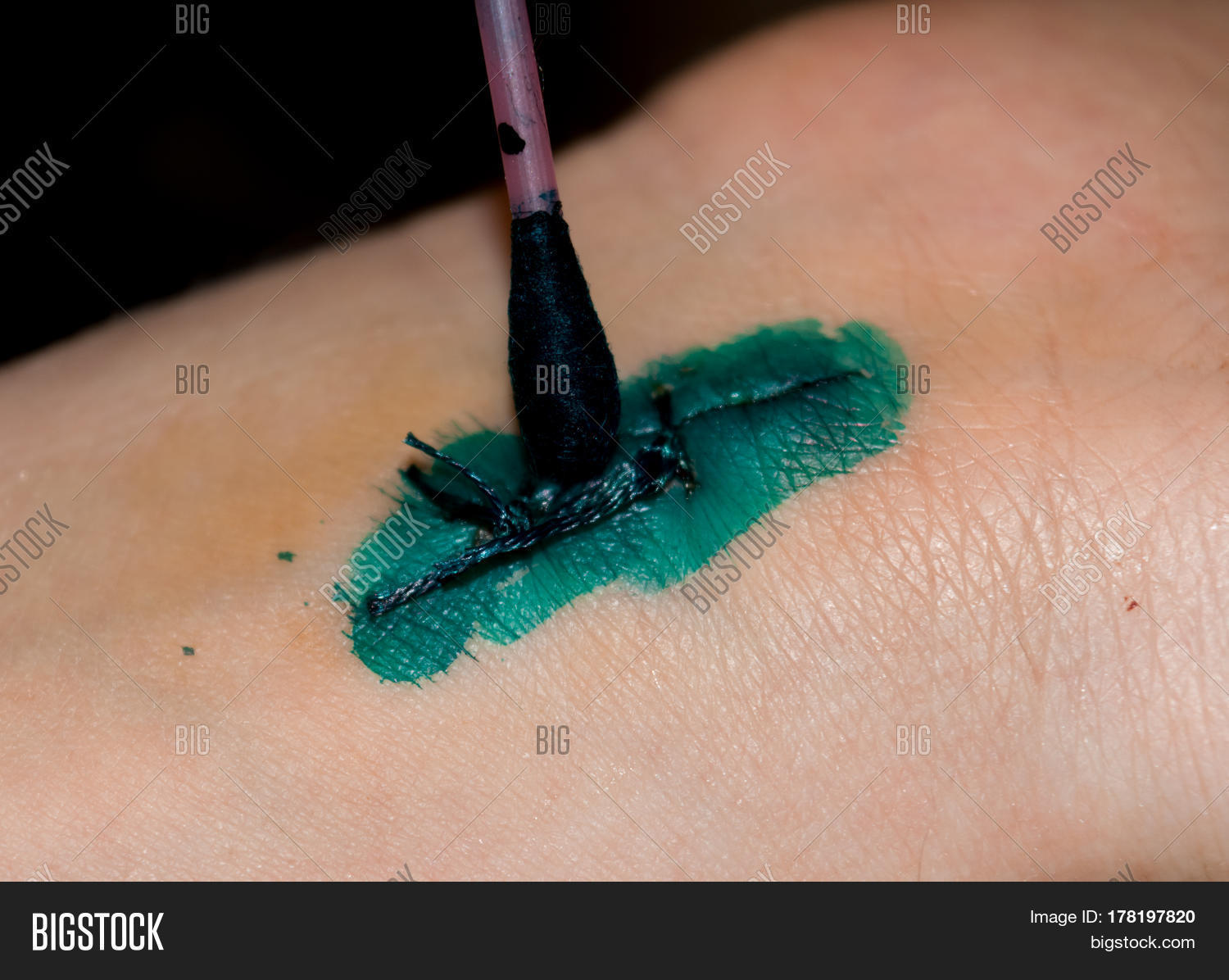 Treatment Sutured Image & Photo (Free Trial) | Bigstock