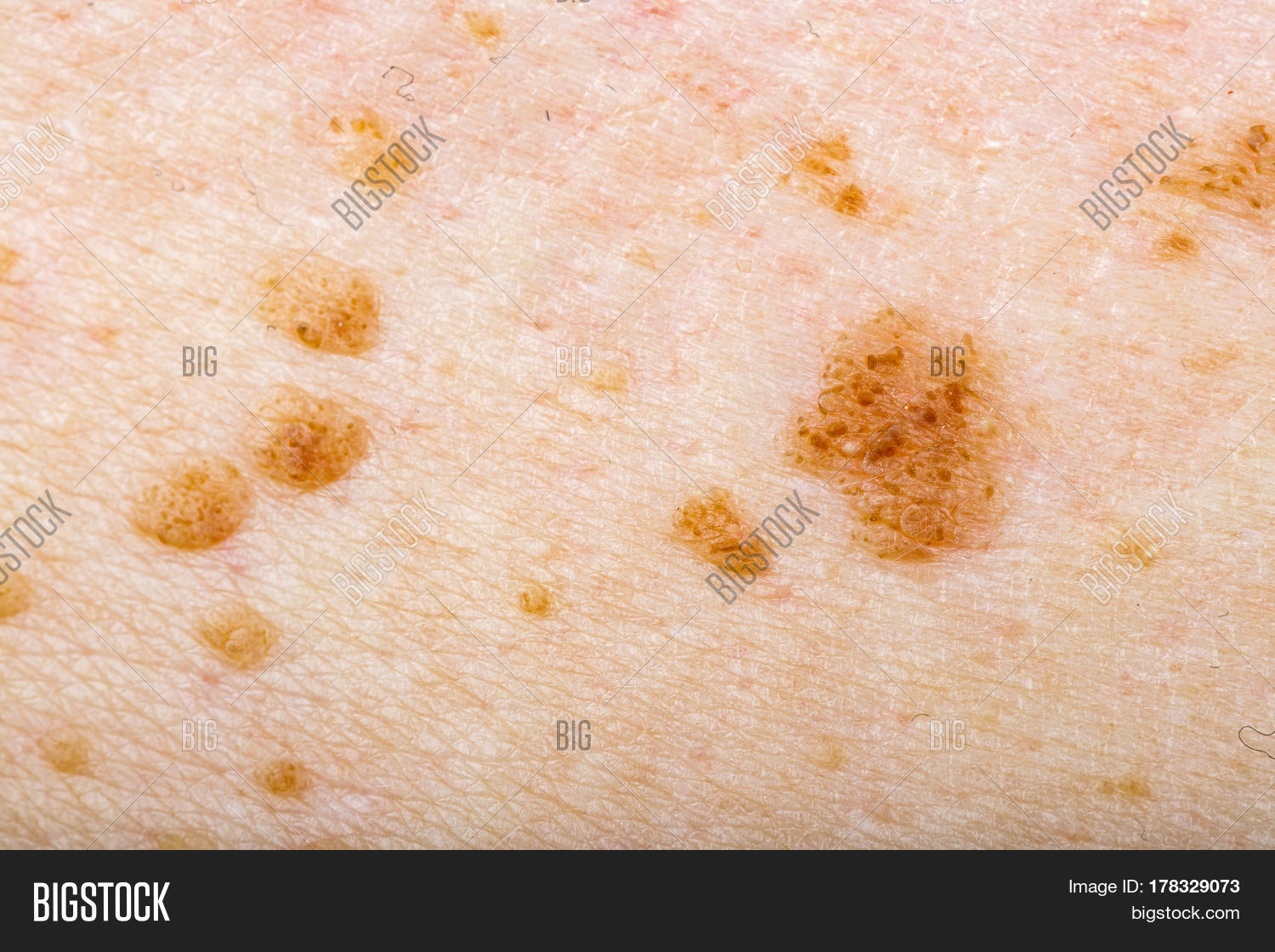 Close Photo Many Nevus Image & Photo (Free Trial) | Bigstock