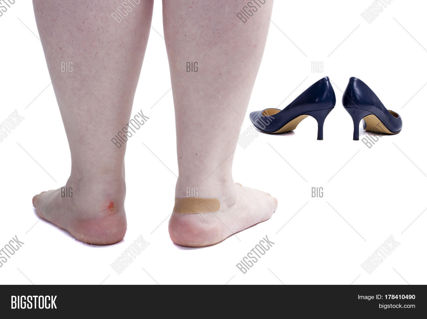 Female Legs Callus On Image & Photo (Free Trial) | Bigstock