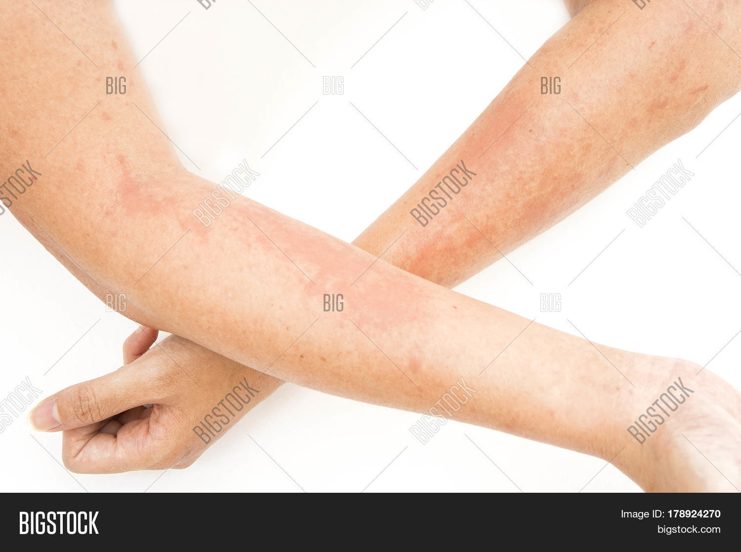 Skin Rashes Allergies Image & Photo (Free Trial) | Bigstock