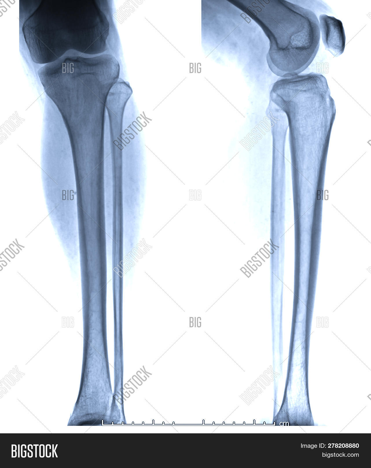 X-ray Image Right Leg Image & Photo (Free Trial) | Bigstock
