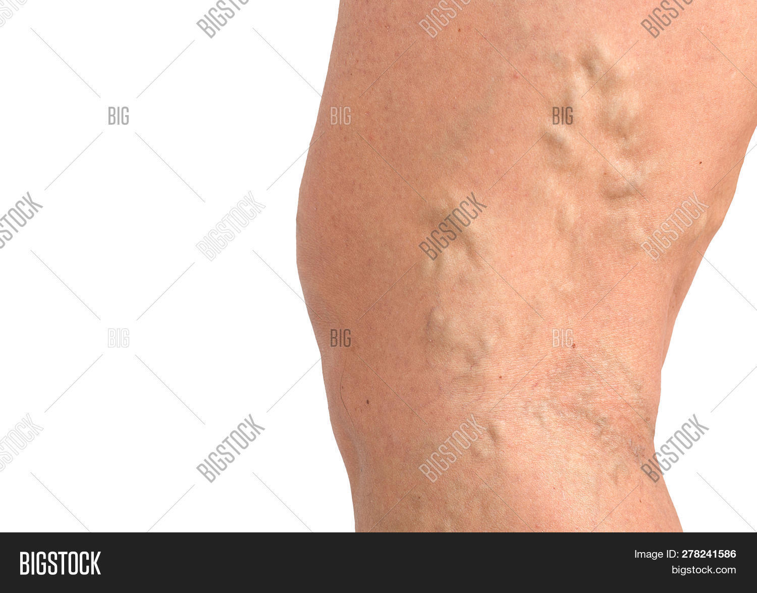 Varicose Veins On Skin Image & Photo (Free Trial) | Bigstock