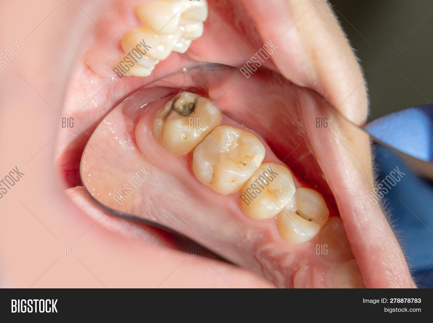 Dental Caries. Filling Image & Photo (Free Trial) | Bigstock