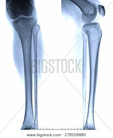 X-ray Image Right Leg Image & Photo (Free Trial) | Bigstock