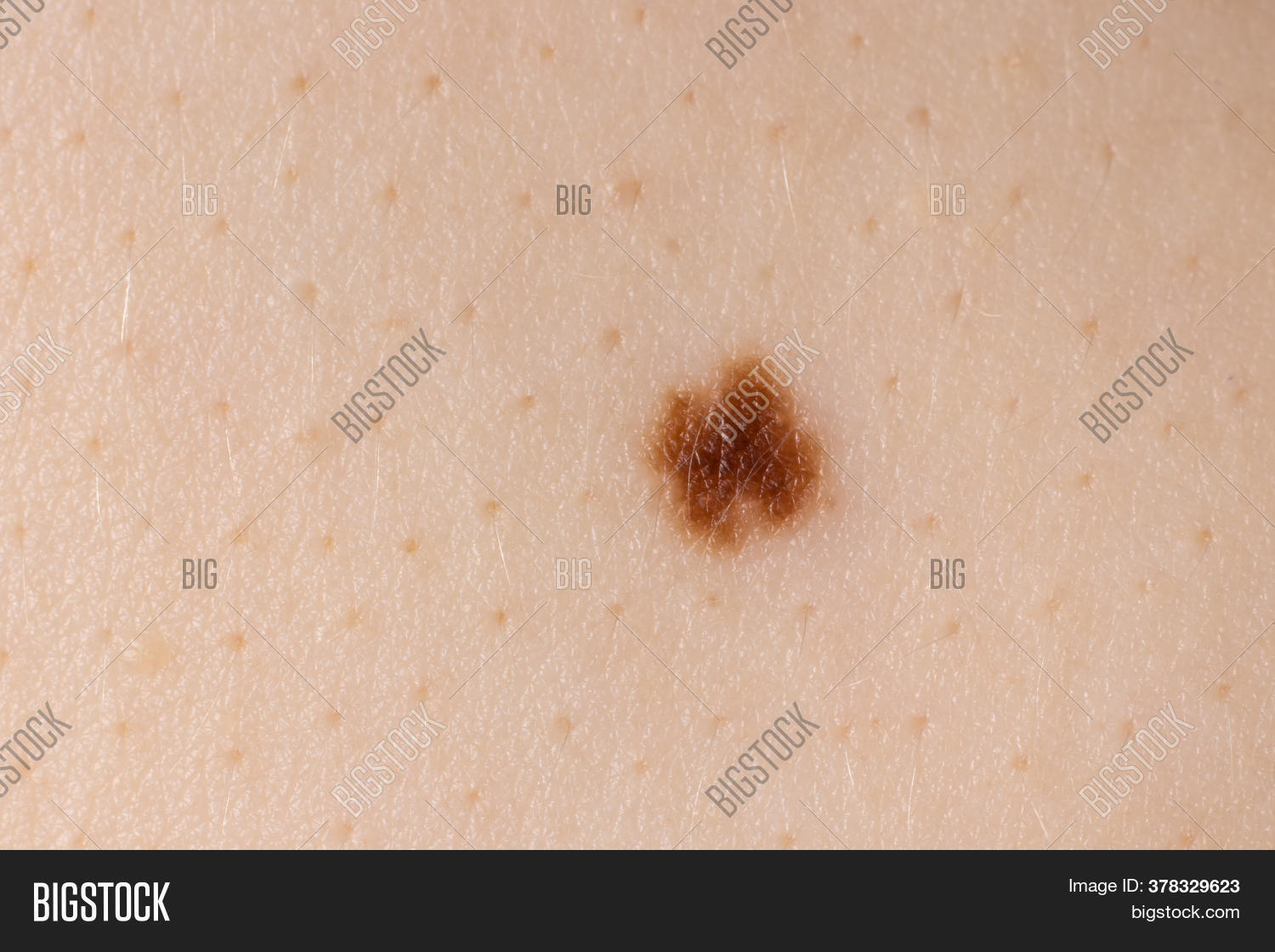 Mole Birthmark Nevus Image & Photo (Free Trial) | Bigstock