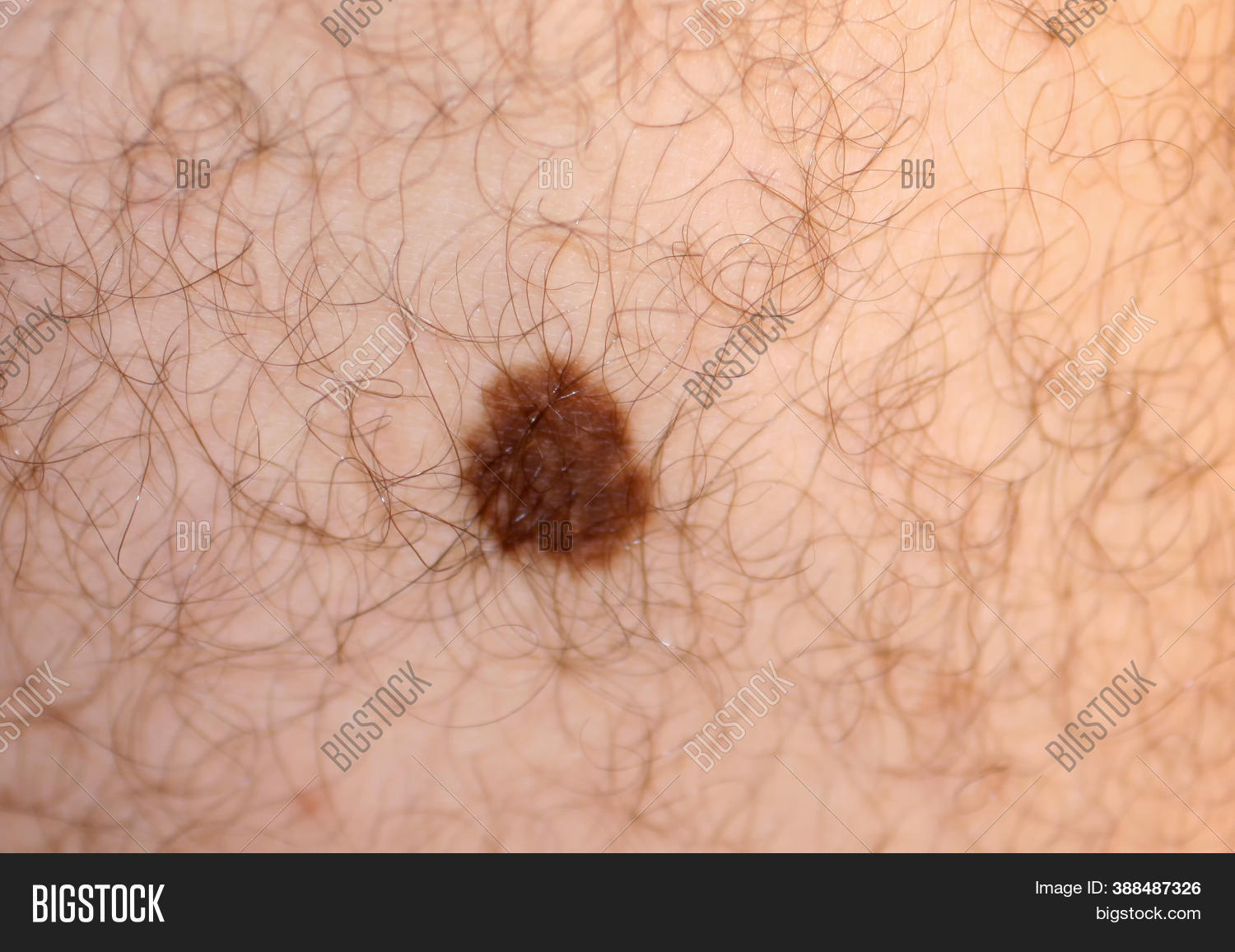 Brown Spot On Skin. Image & Photo (Free Trial) | Bigstock