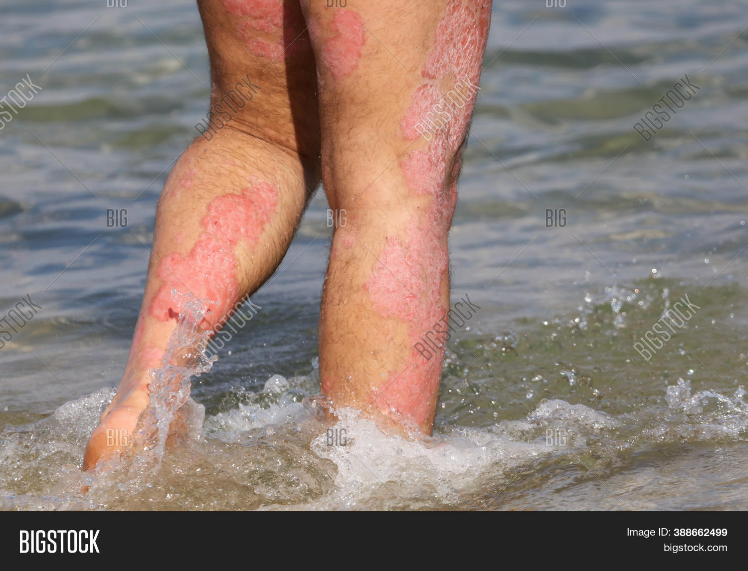 Legs Skin Disease Sea Image & Photo (Free Trial) | Bigstock