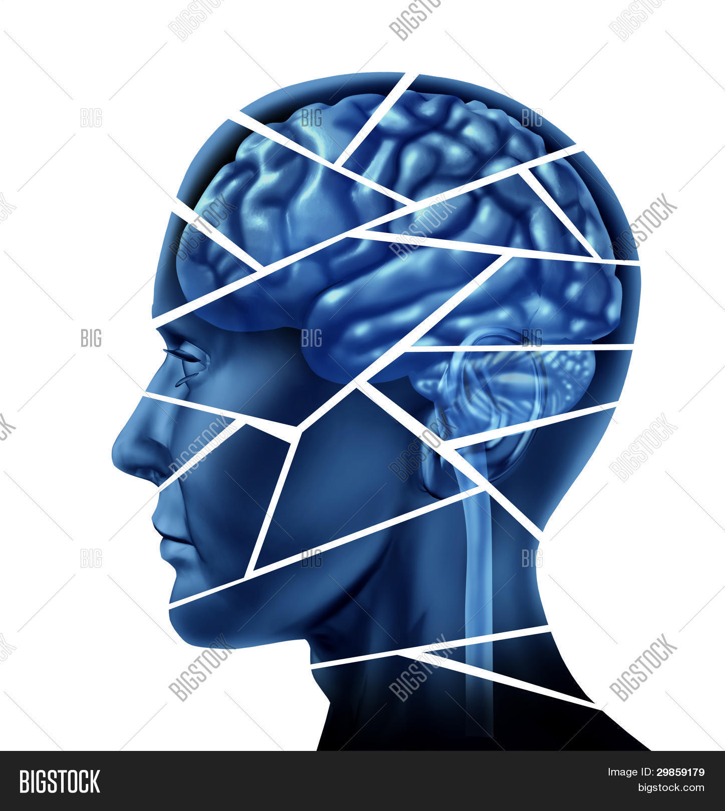Brain Injury Image & Photo (Free Trial) | Bigstock