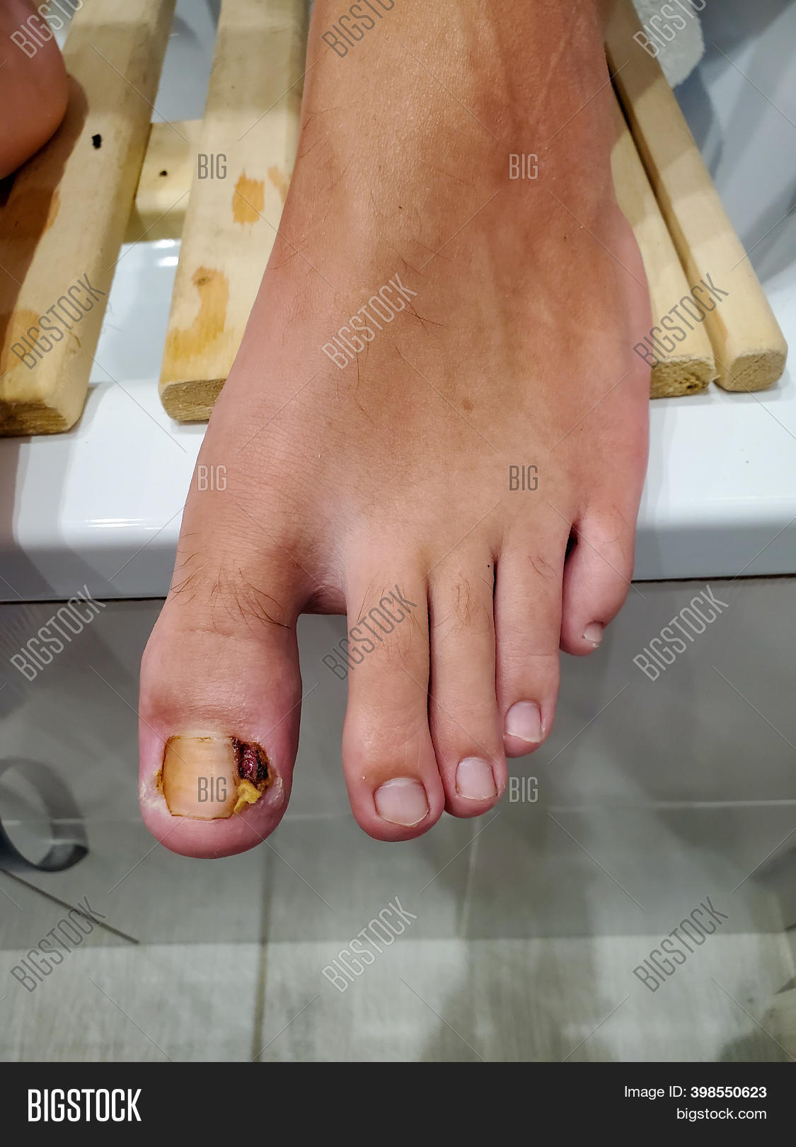 Treat Inflamed Big Toe Image & Photo (Free Trial) | Bigstock