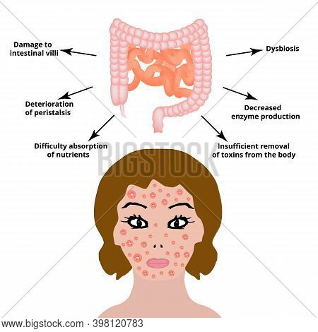 The Anatomical Structure Of The Intestine. Bowel Diseases Affect The ...