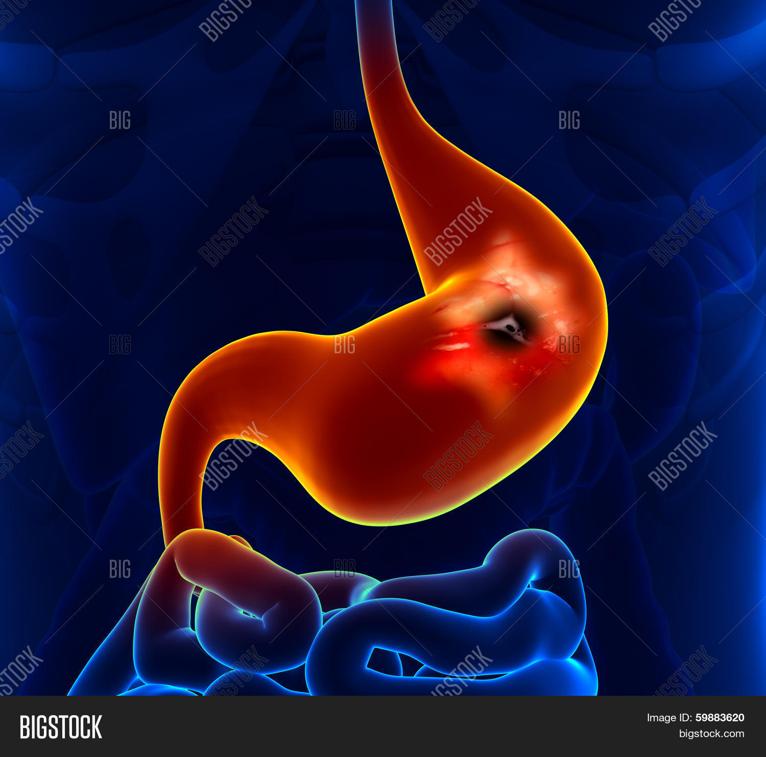 Peptic Ulcer - Stomach Image & Photo (Free Trial) | Bigstock