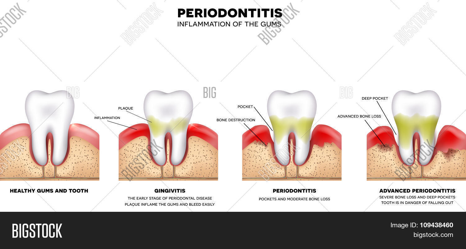 Periodontitis Vector & Photo (Free Trial) | Bigstock