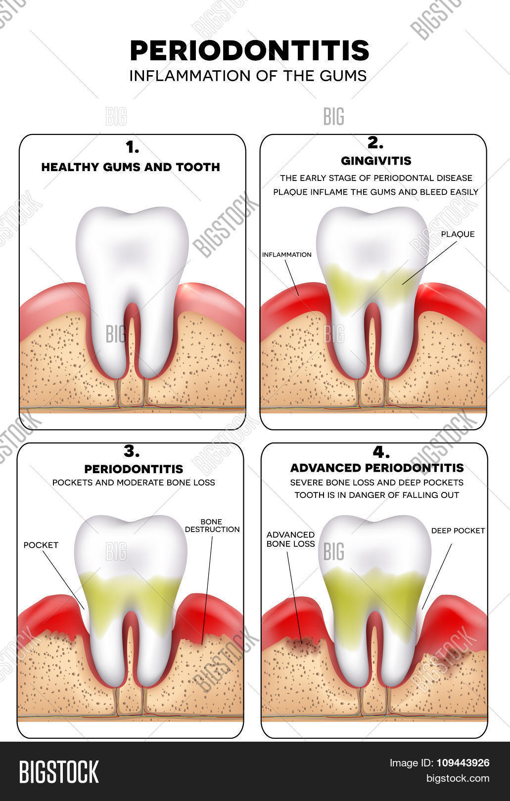 Periodontitis Vector & Photo (Free Trial) | Bigstock