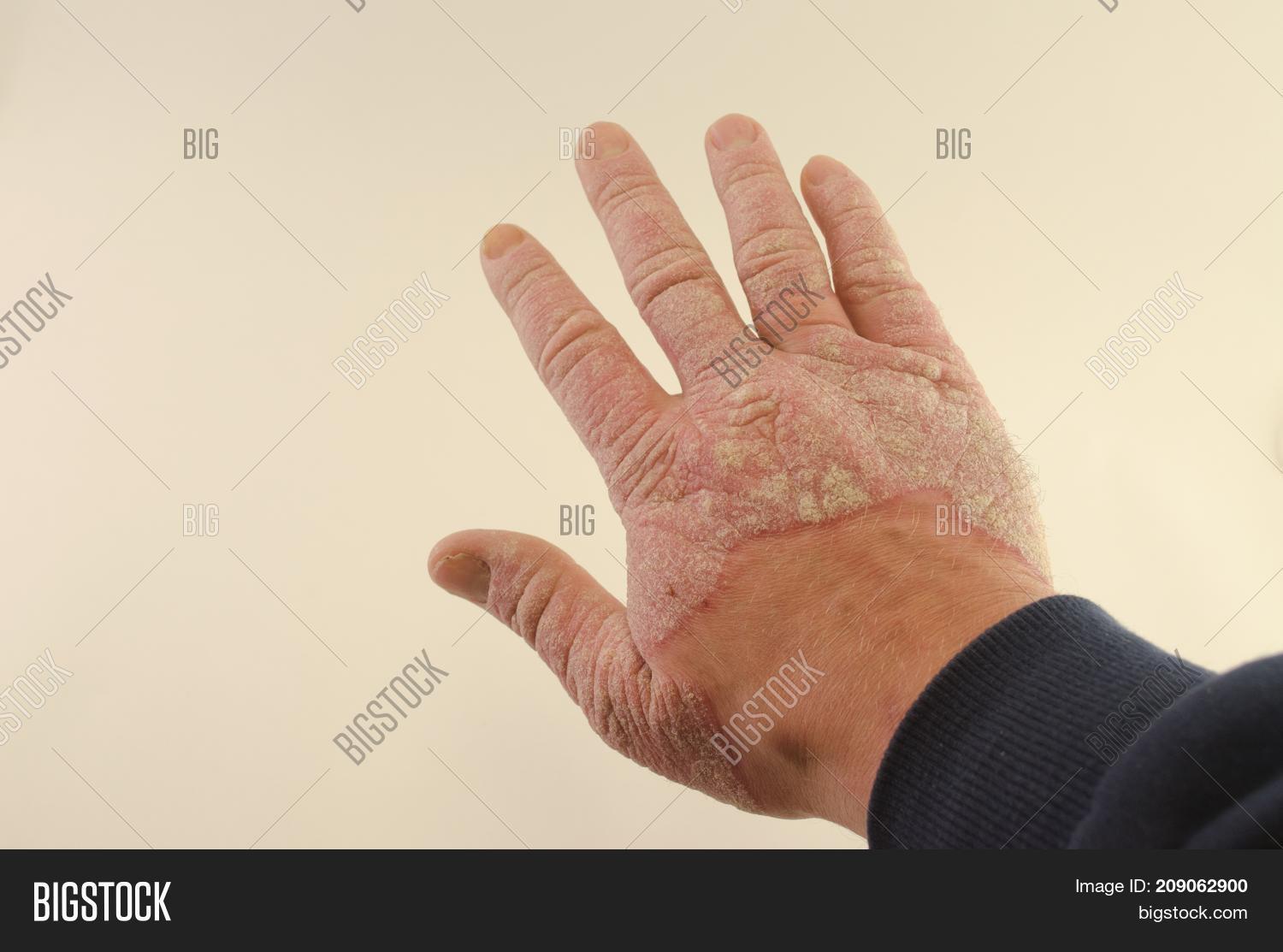 Psoriasis On Hand Image & Photo (Free Trial) | Bigstock