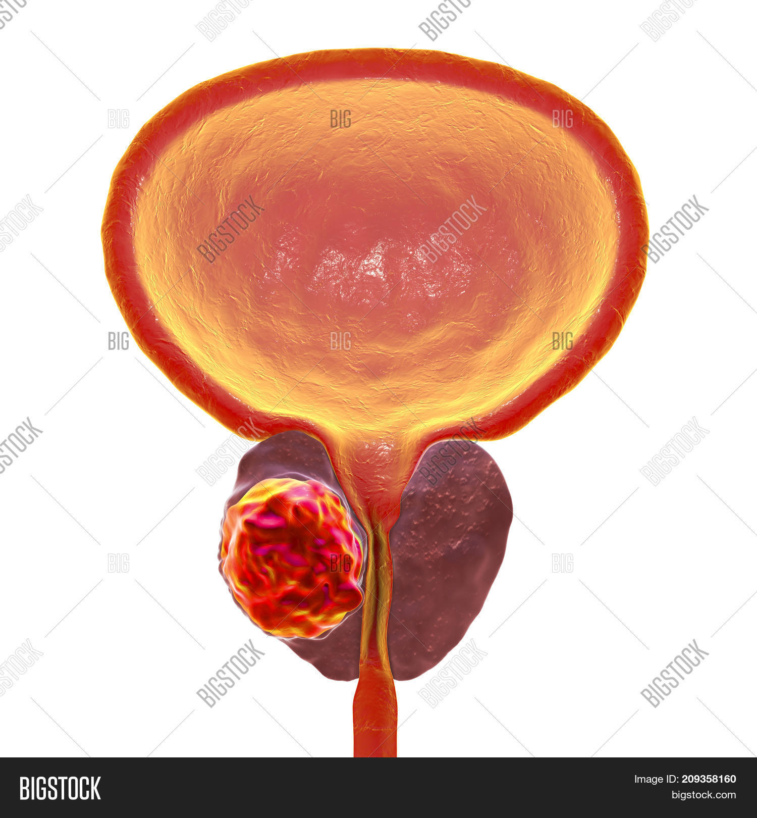 Prostate Cancer, 3D Image & Photo (Free Trial) | Bigstock