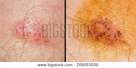 Ringworm Skin. Macro Image & Photo (Free Trial) | Bigstock