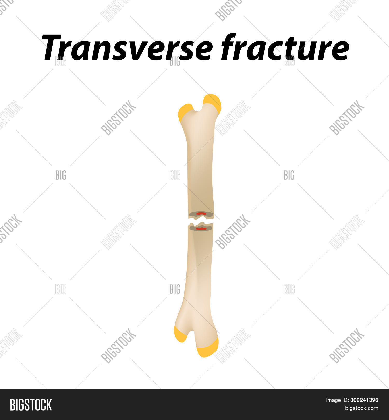 Transverse Bone Image & Photo (Free Trial) | Bigstock