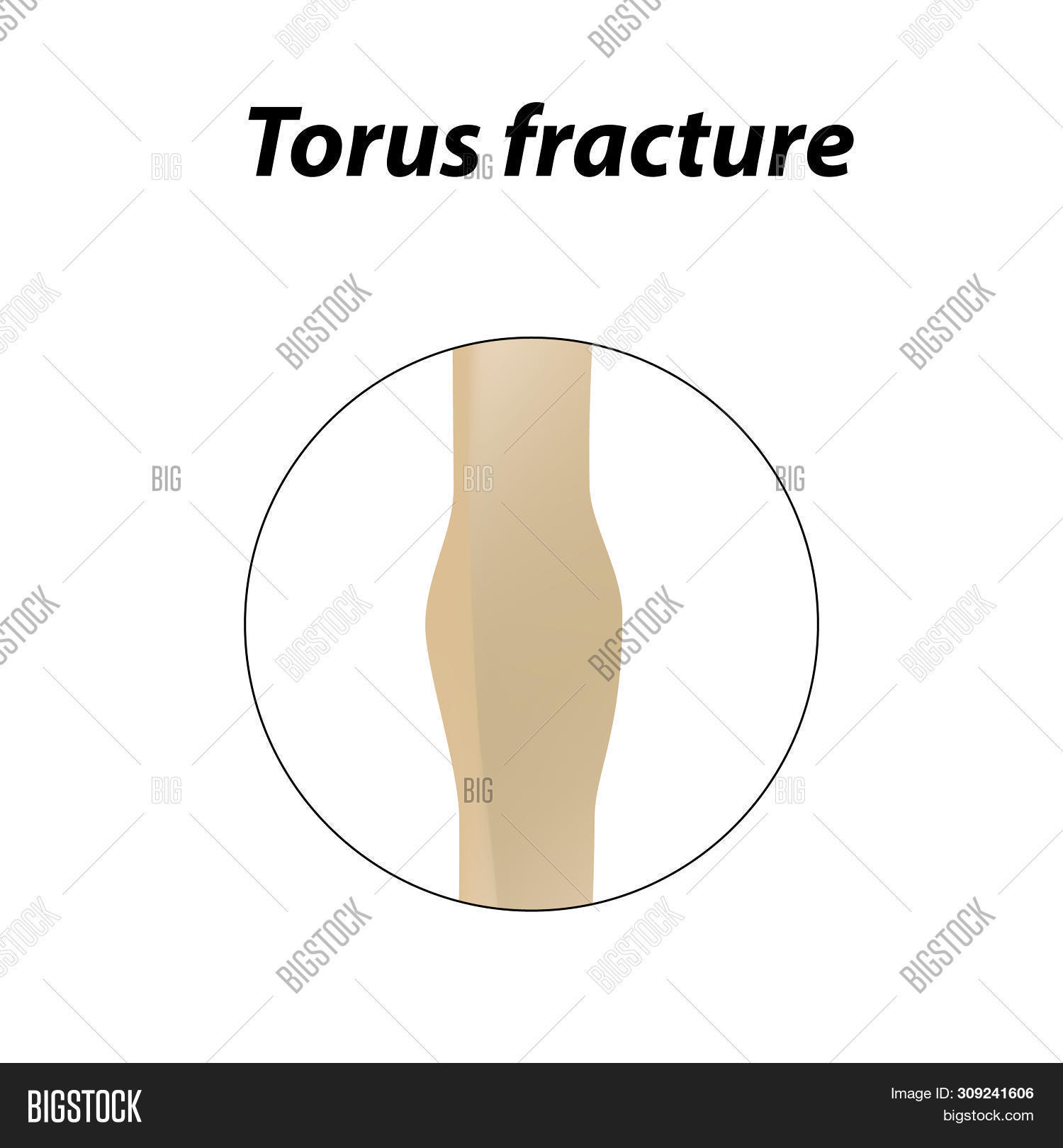 Torus Fracture Bone. Image & Photo (Free Trial) | Bigstock