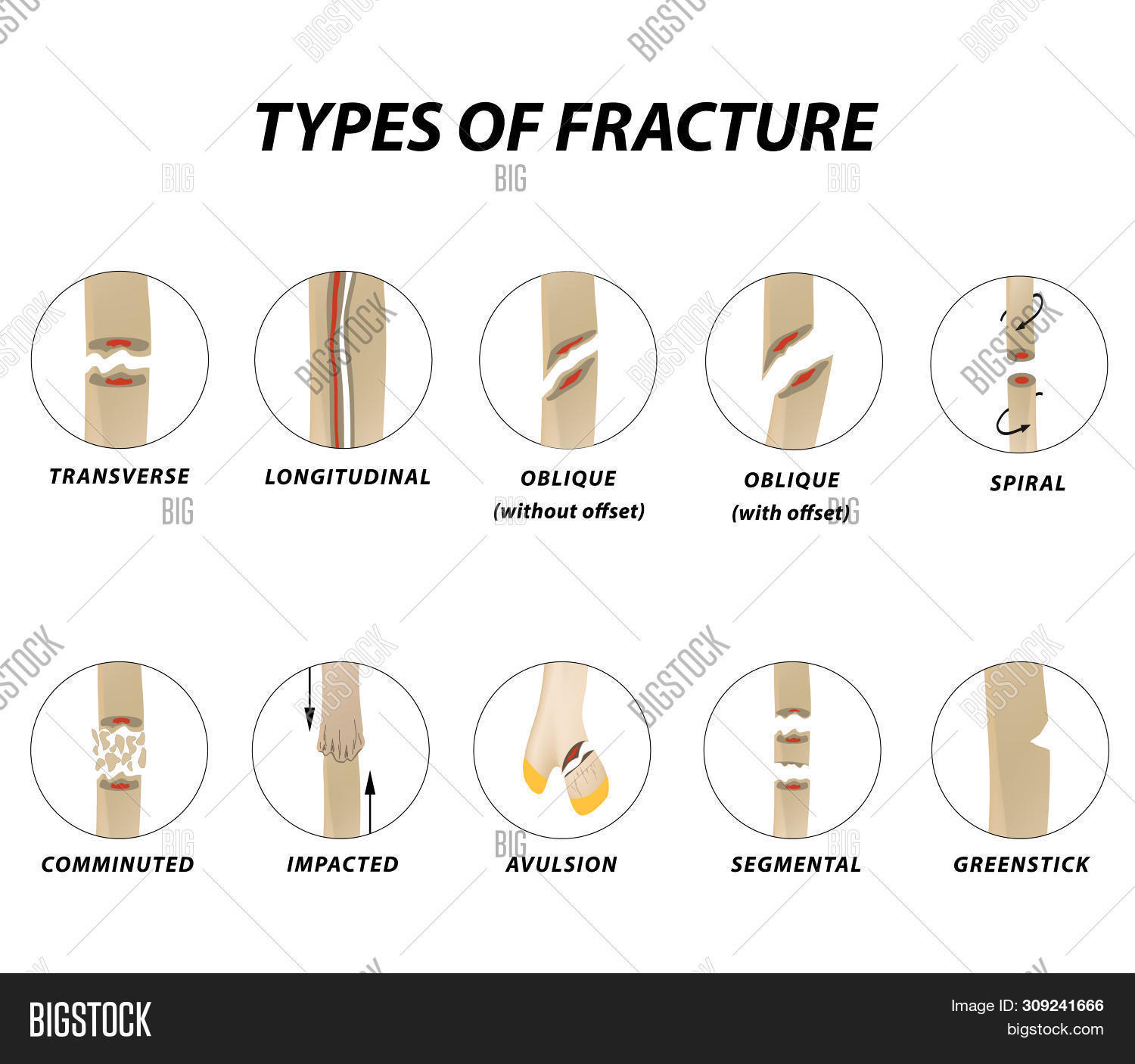 Types Fracture. Image & Photo (Free Trial) | Bigstock