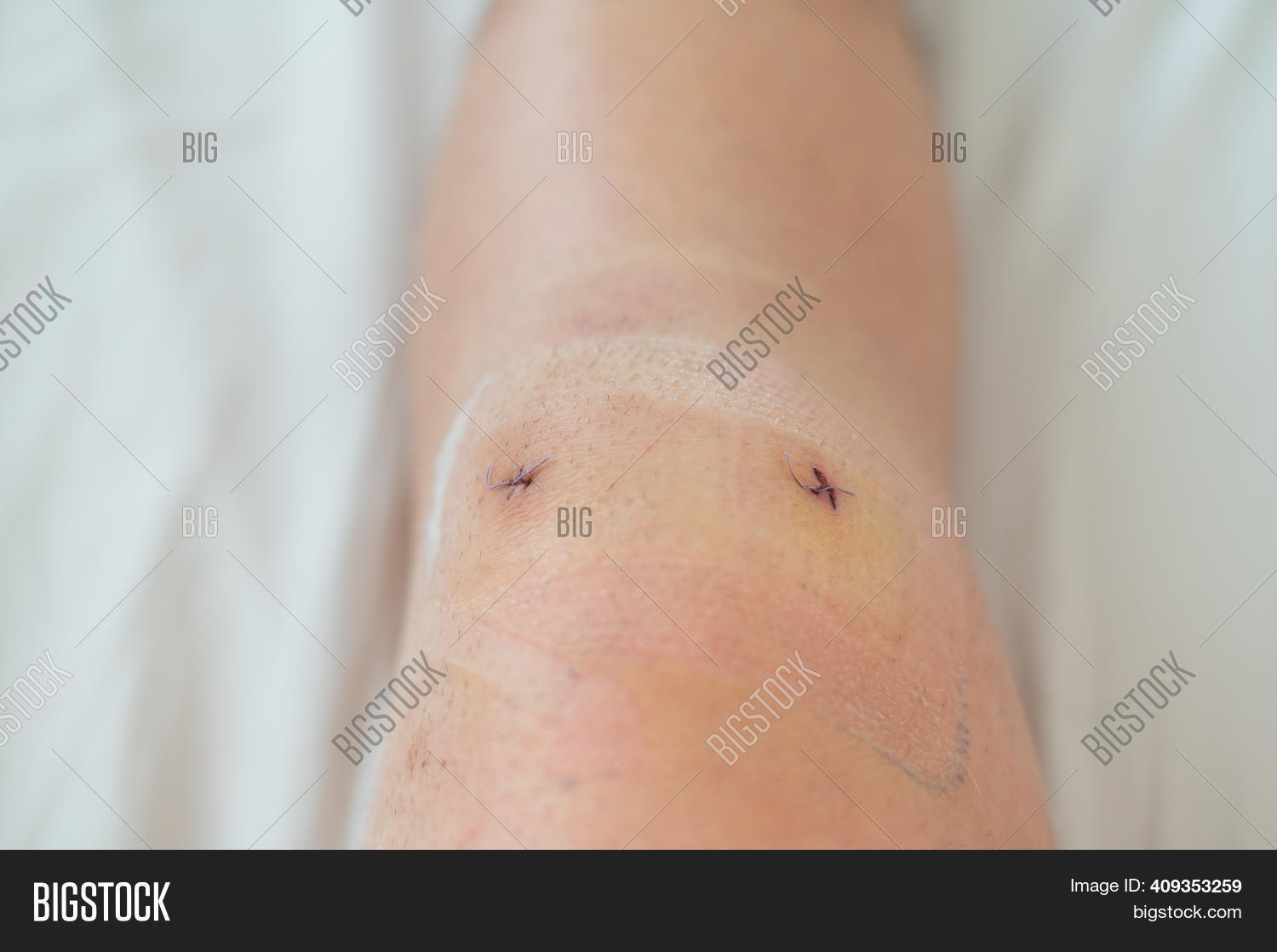 Close- Surgical Suture Image & Photo (Free Trial) | Bigstock