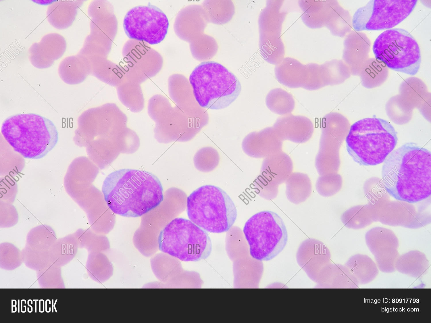 Lymphoblast Image & Photo (Free Trial) | Bigstock