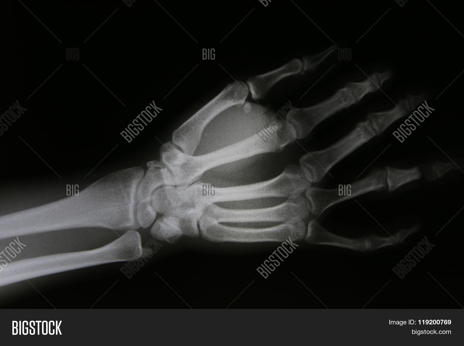 X-rays Images Bone Image & Photo (Free Trial) | Bigstock
