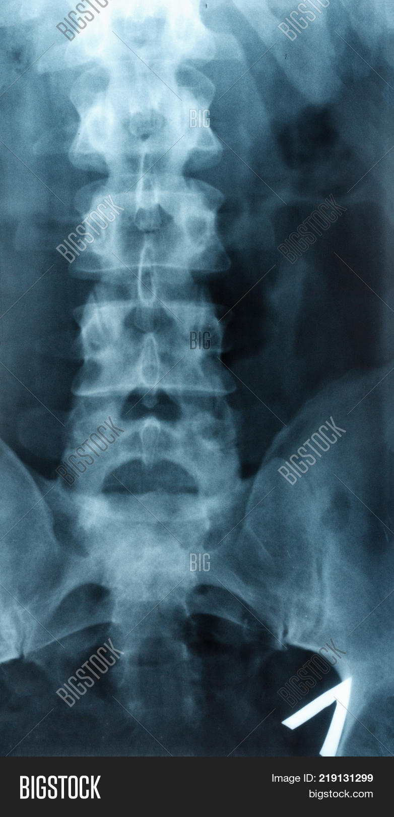 Film X-ray Lumbar Image & Photo (Free Trial) | Bigstock