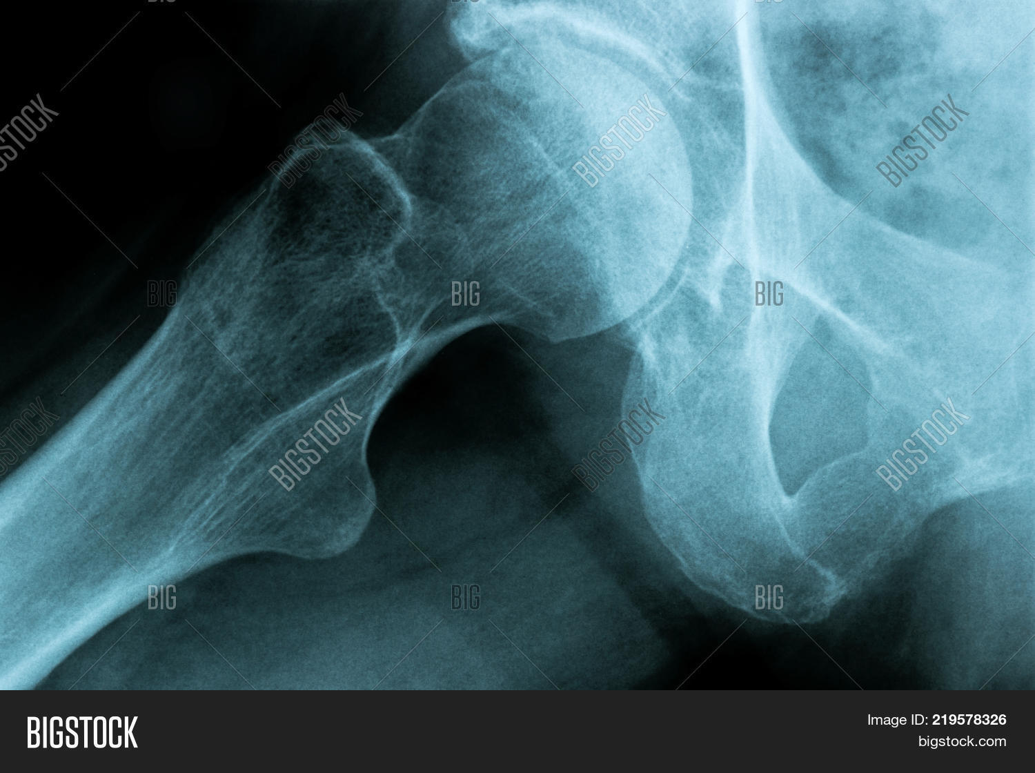 Left Chest Hip Joint X Image & Photo (Free Trial) | Bigstock