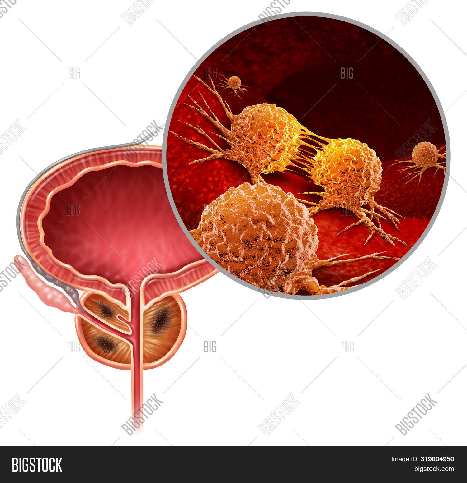 Cancer Prostate Image & Photo (Free Trial) | Bigstock