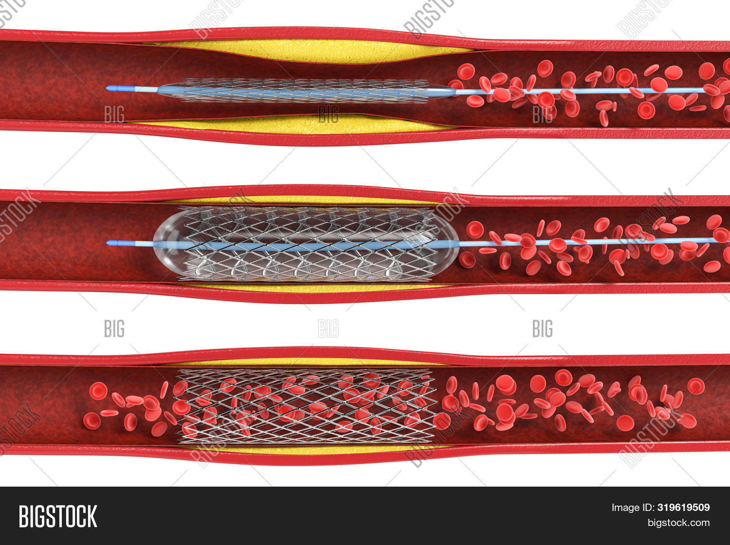 Balloon Angioplasty Image & Photo (Free Trial) | Bigstock