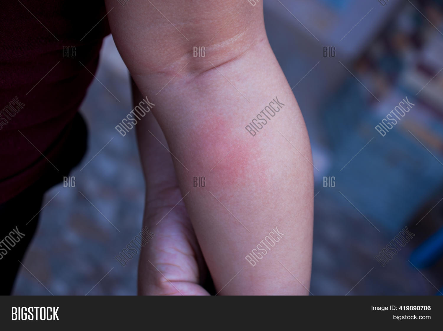 Mosquito Bite On Calf Image & Photo (Free Trial) | Bigstock