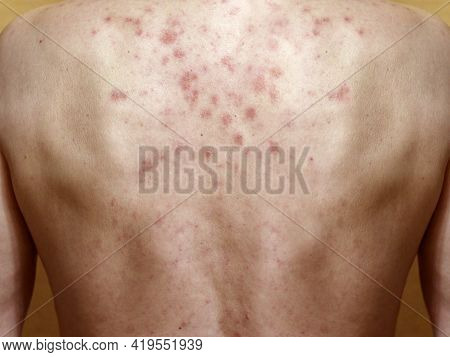 Dermatitis On Skin Man Image & Photo (Free Trial) | Bigstock