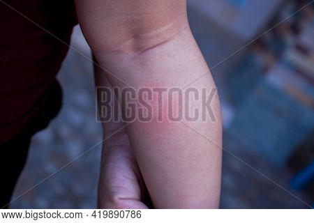 Mosquito Bite On Calf Image & Photo (Free Trial) | Bigstock