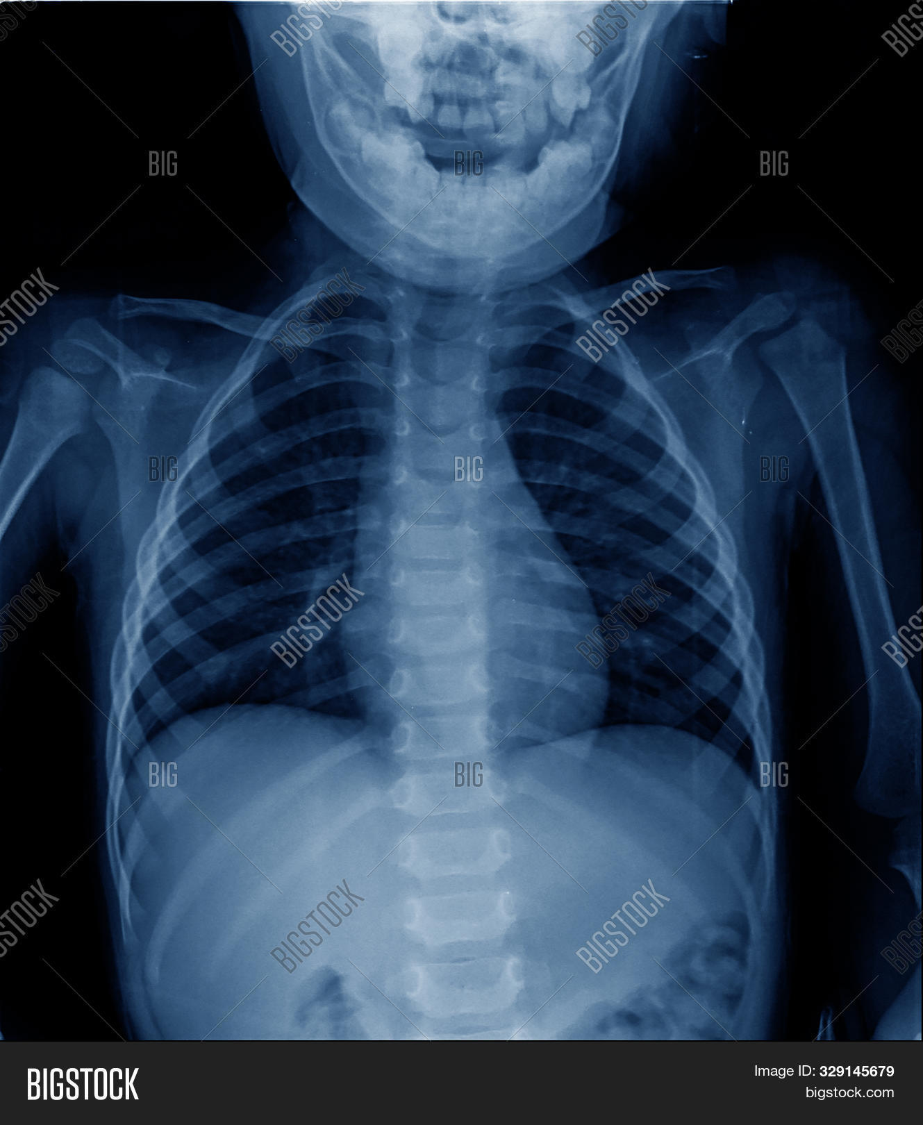 Chest X-ray Child Show Image & Photo (Free Trial) | Bigstock