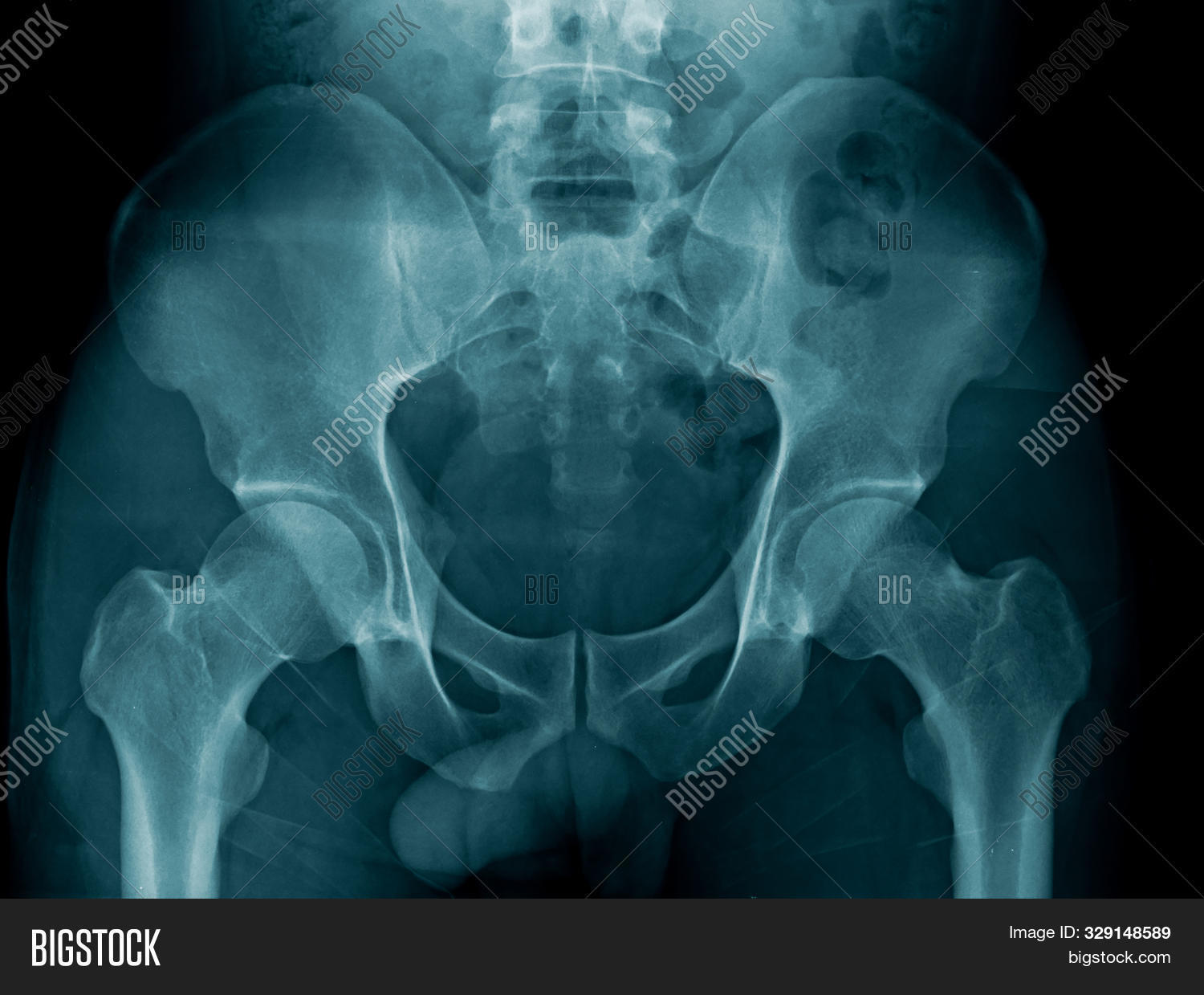 X-ray Image Pelvic Image & Photo (Free Trial) | Bigstock
