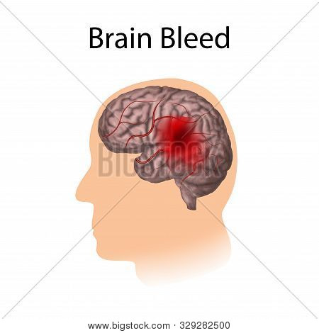 Brain Bleed. Image & Photo (Free Trial) | Bigstock