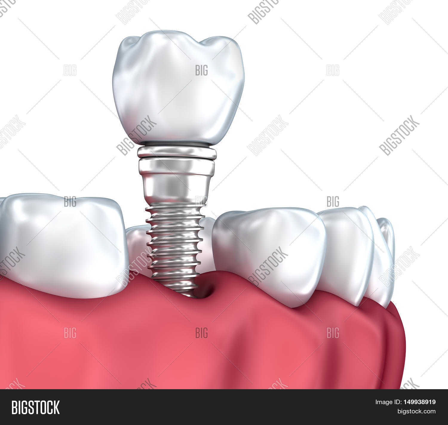 Tooth Human Implant Image & Photo (Free Trial) | Bigstock