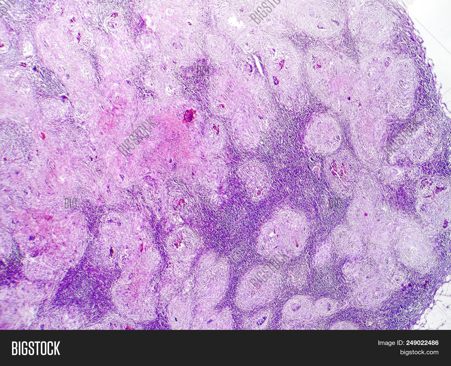 Caseous Necrosis Image & Photo (Free Trial) | Bigstock