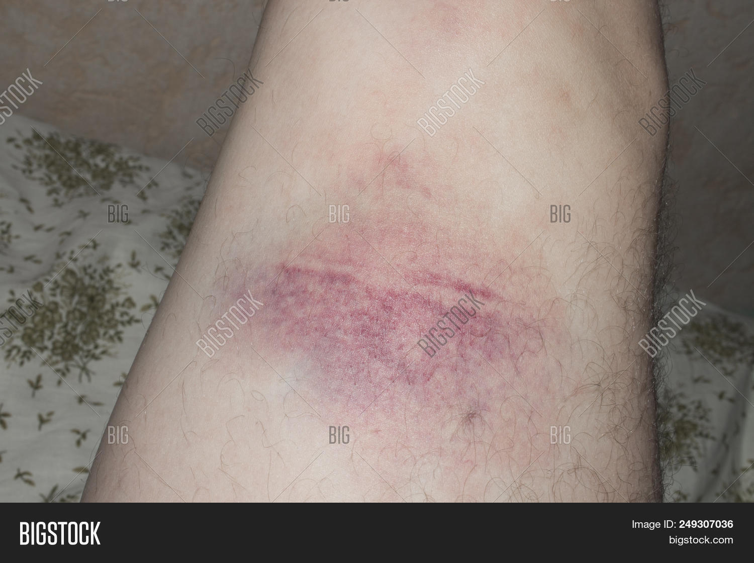 Damaged Swollen Knee Image & Photo (Free Trial) | Bigstock