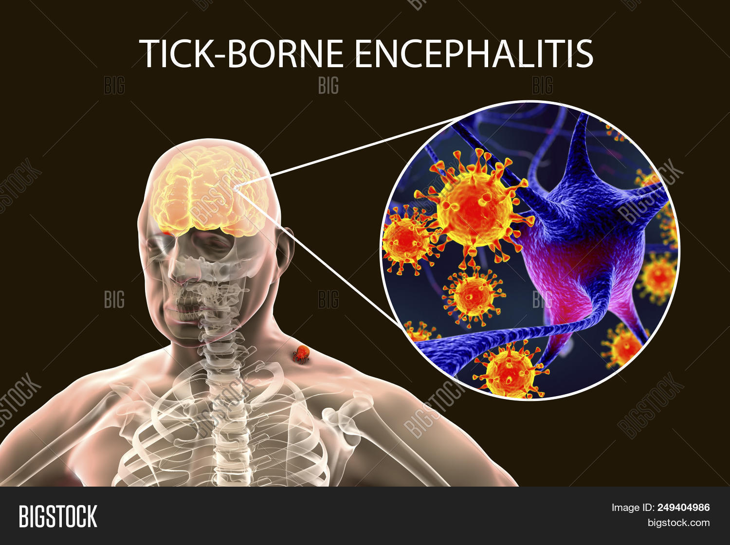 Tick-borne Image & Photo (Free Trial) | Bigstock