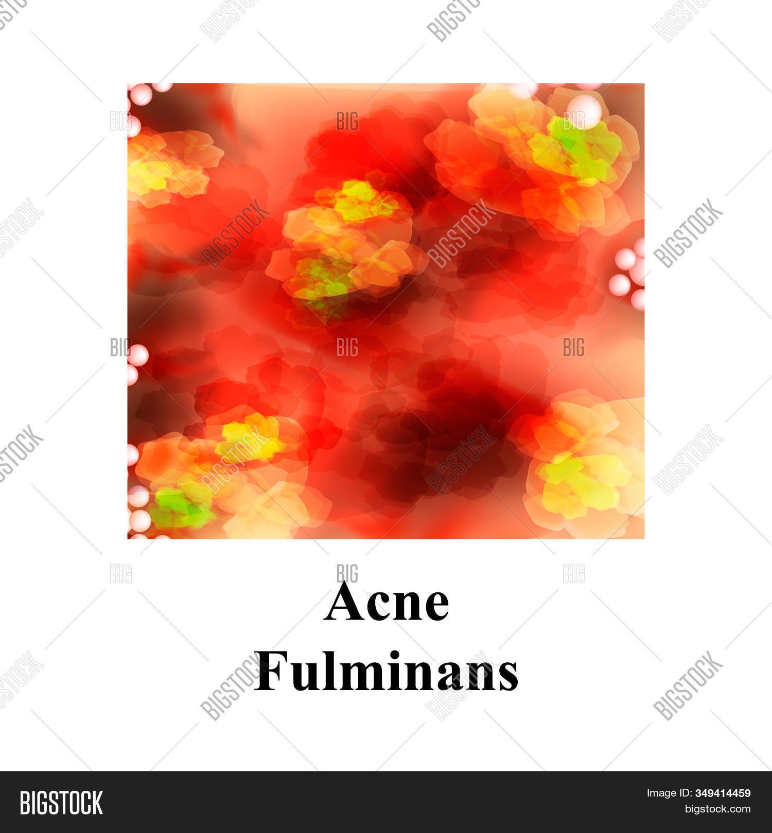 Pustules On Skin. Acne Image & Photo (Free Trial) | Bigstock