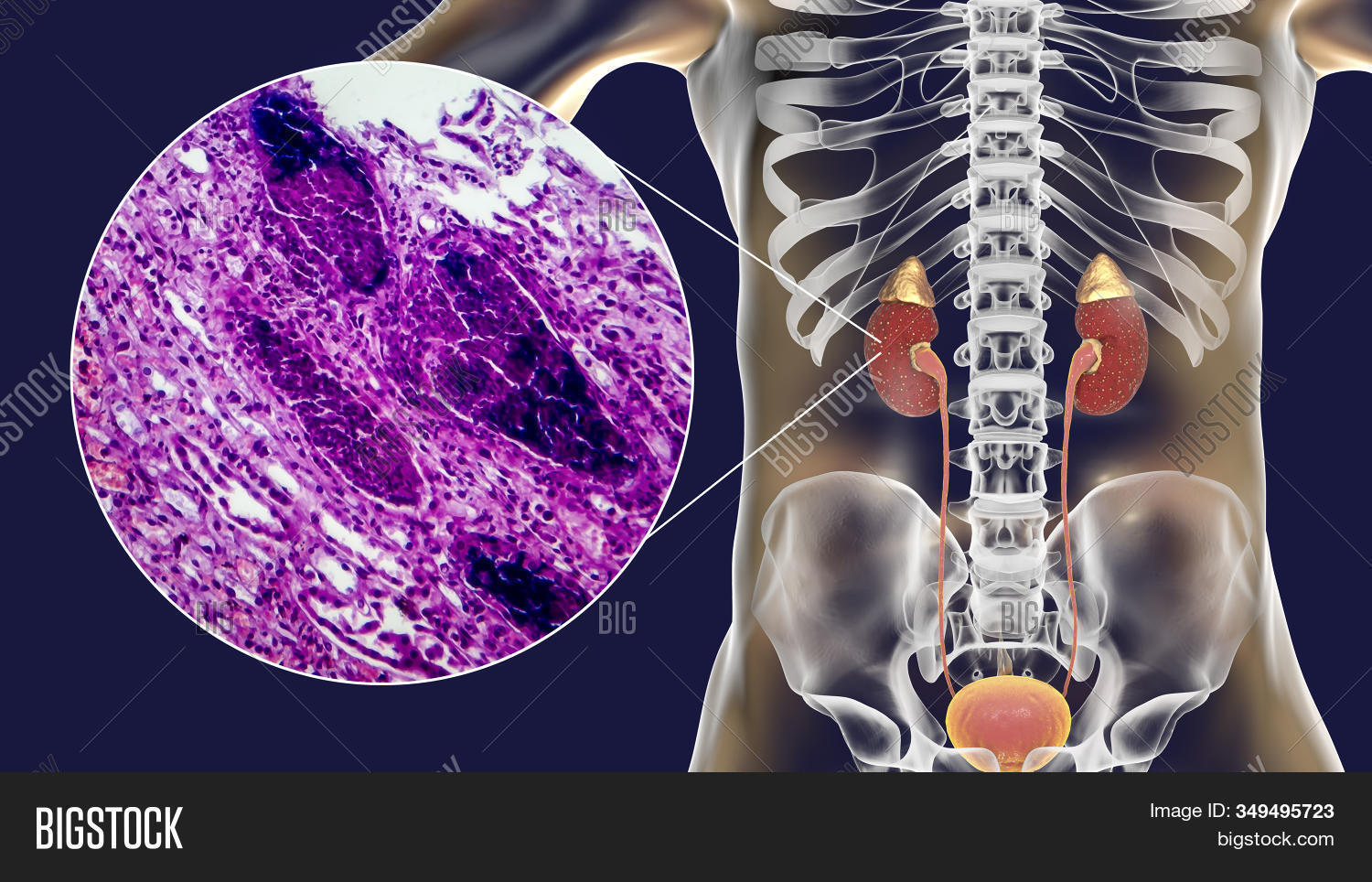 Acute Pyelonephritis, Image & Photo (Free Trial) | Bigstock