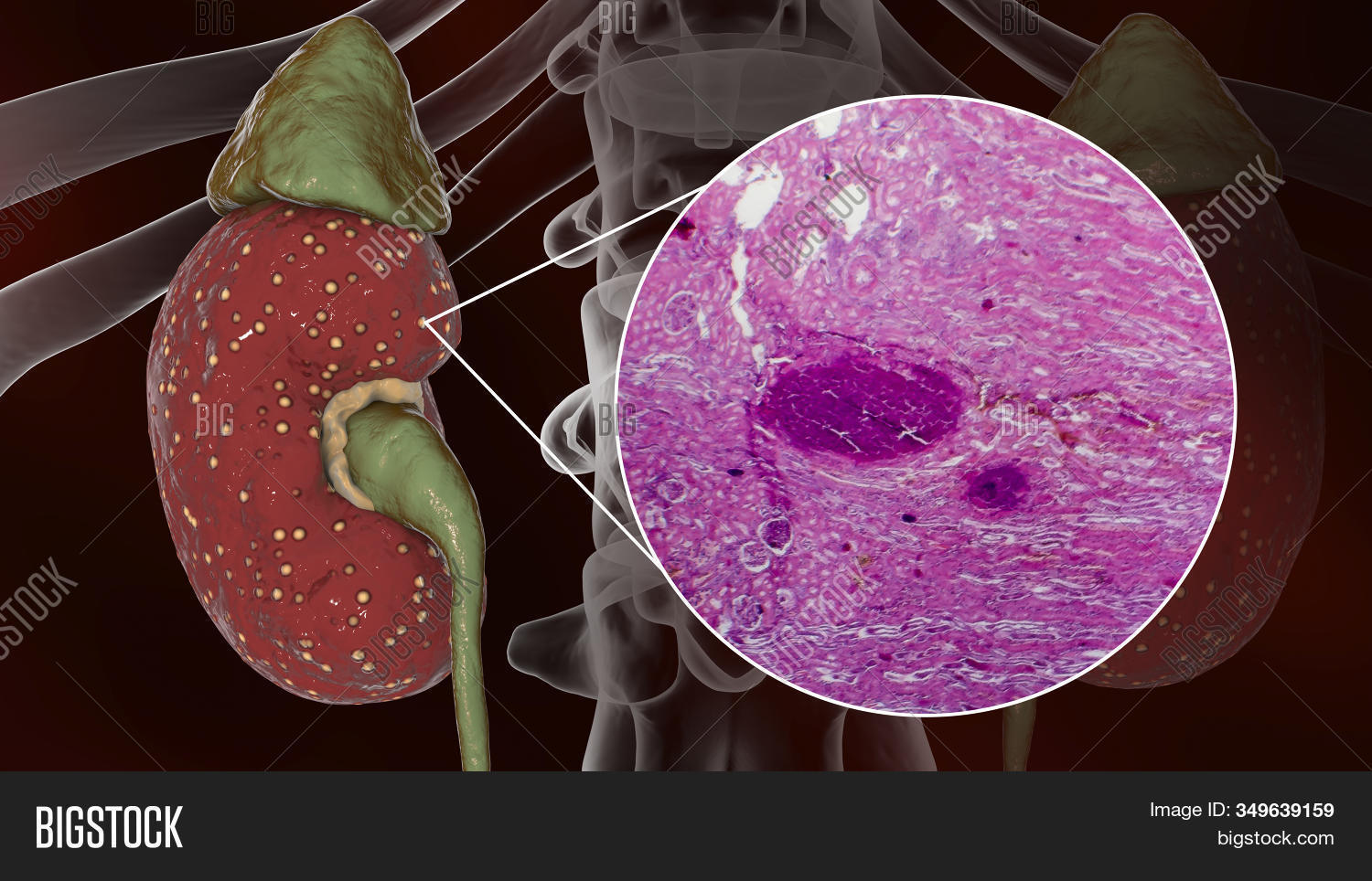 Acute Pyelonephritis, Image & Photo (Free Trial) | Bigstock