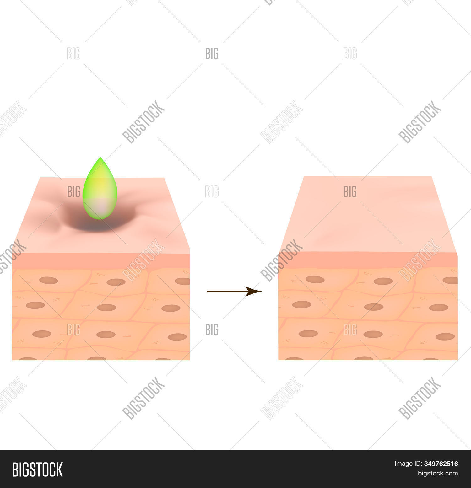 Acne Scars. Acid Image & Photo (Free Trial) | Bigstock