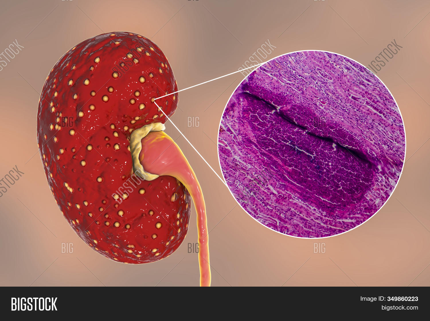 Acute Pyelonephritis, Image & Photo (Free Trial) | Bigstock