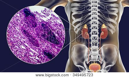 Acute Pyelonephritis, Image & Photo (Free Trial) | Bigstock