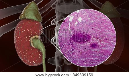 Acute Pyelonephritis, Image & Photo (Free Trial) | Bigstock
