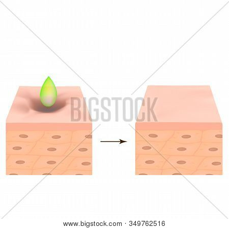 Acne Scars. Acid Image & Photo (Free Trial) | Bigstock