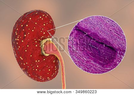 Acute Pyelonephritis, Image & Photo (Free Trial) | Bigstock